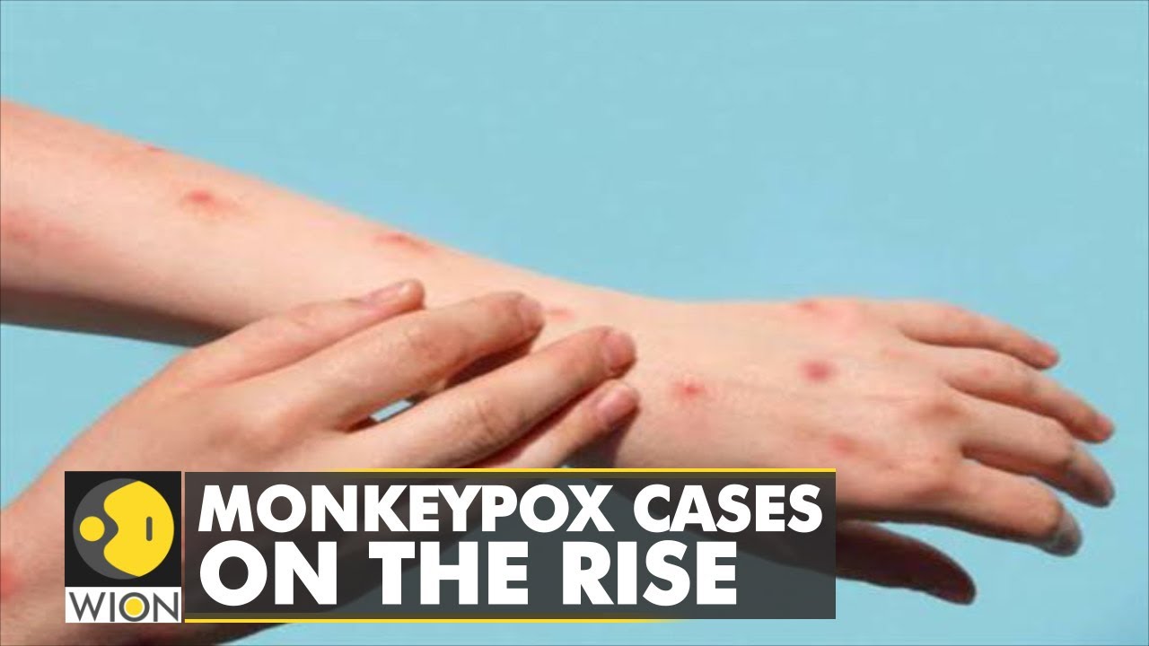 Monkeypox cases on the rise: What are the key symptoms of infection ...
