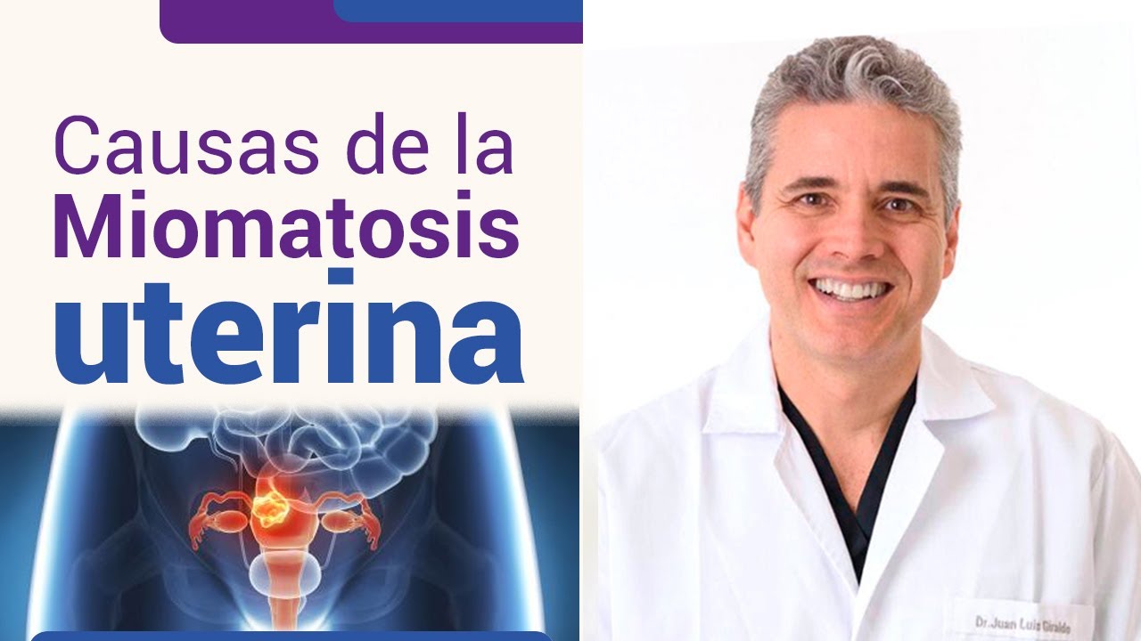 ¿Por qué salen los miomas? Causas explicada - Dr. Juan Luis Giraldo ...