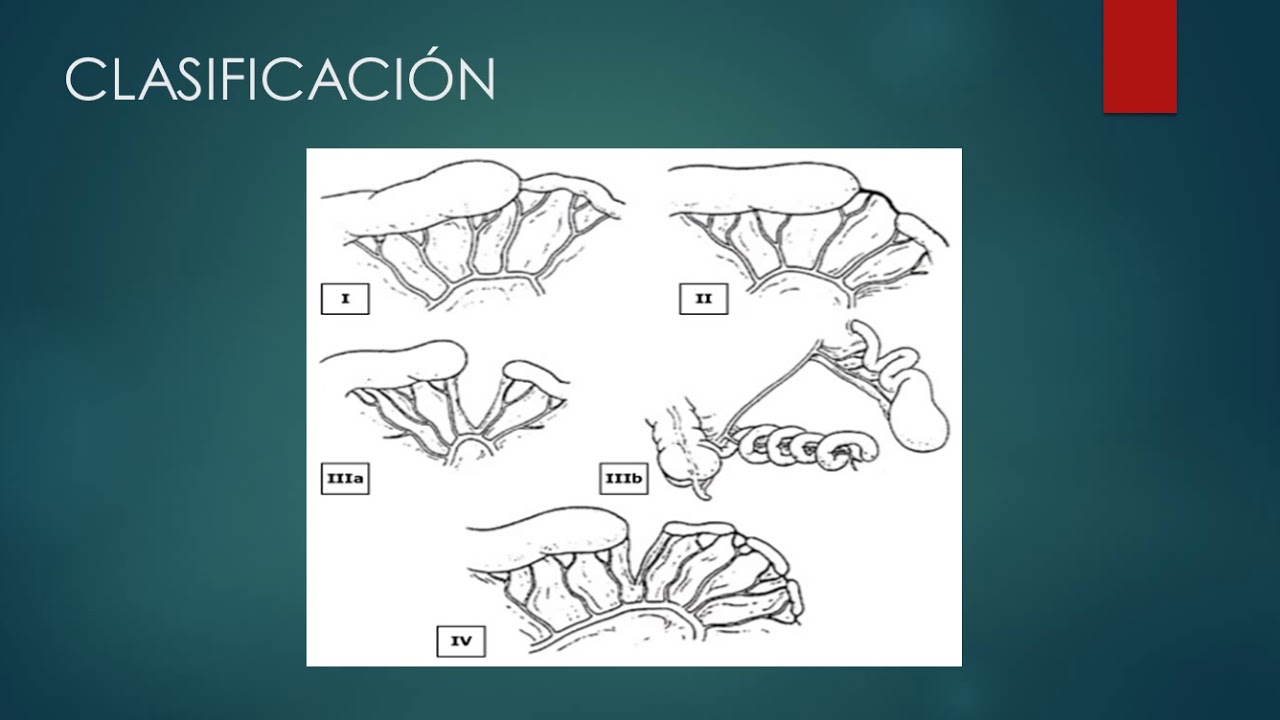 14 Avances en atresia intestinal - YouTube