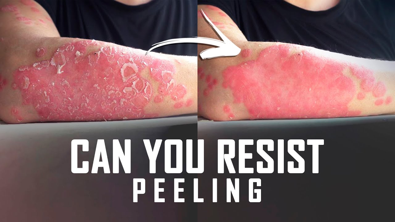 CRISPY to SMOOTH | Psoriasis skin care - YouTube