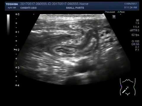 Ultrasound Video showing focusing of inflamed appendix. - YouTube