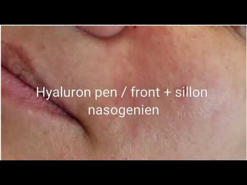 Hyaluron acid pour front et sillon nasogénien😍😍😍 - YouTube