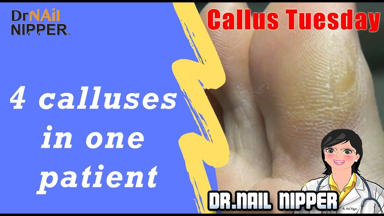 What causes foot callus? Four Calluses in One Patient - Callus Tuesday ...