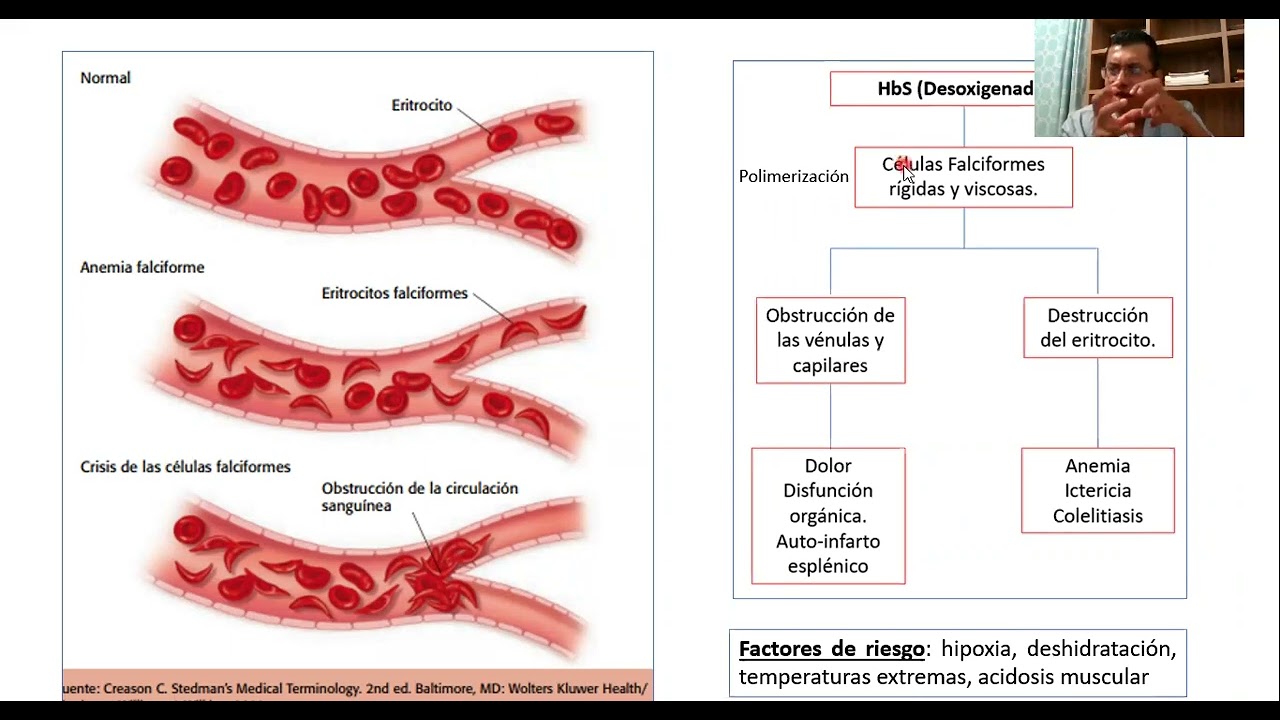 ANEMIA DE CÉLULAS FALCIFORME. Parte 1 - YouTube