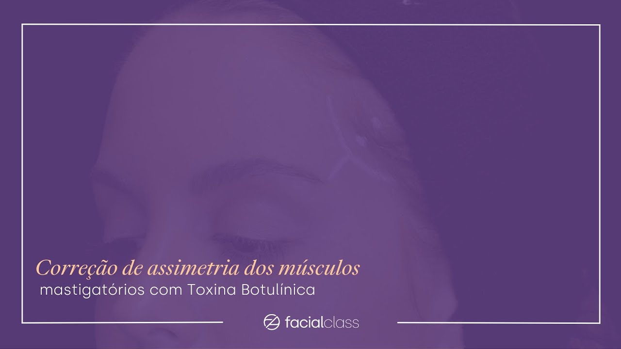 Correção de assimetria dos músculos mastigatórios com Toxina Botulínica ...
