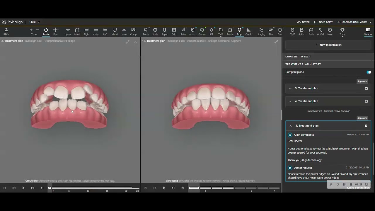 Invisalign First for Phase 1 Orthodontics Instead of Palate Expander ...