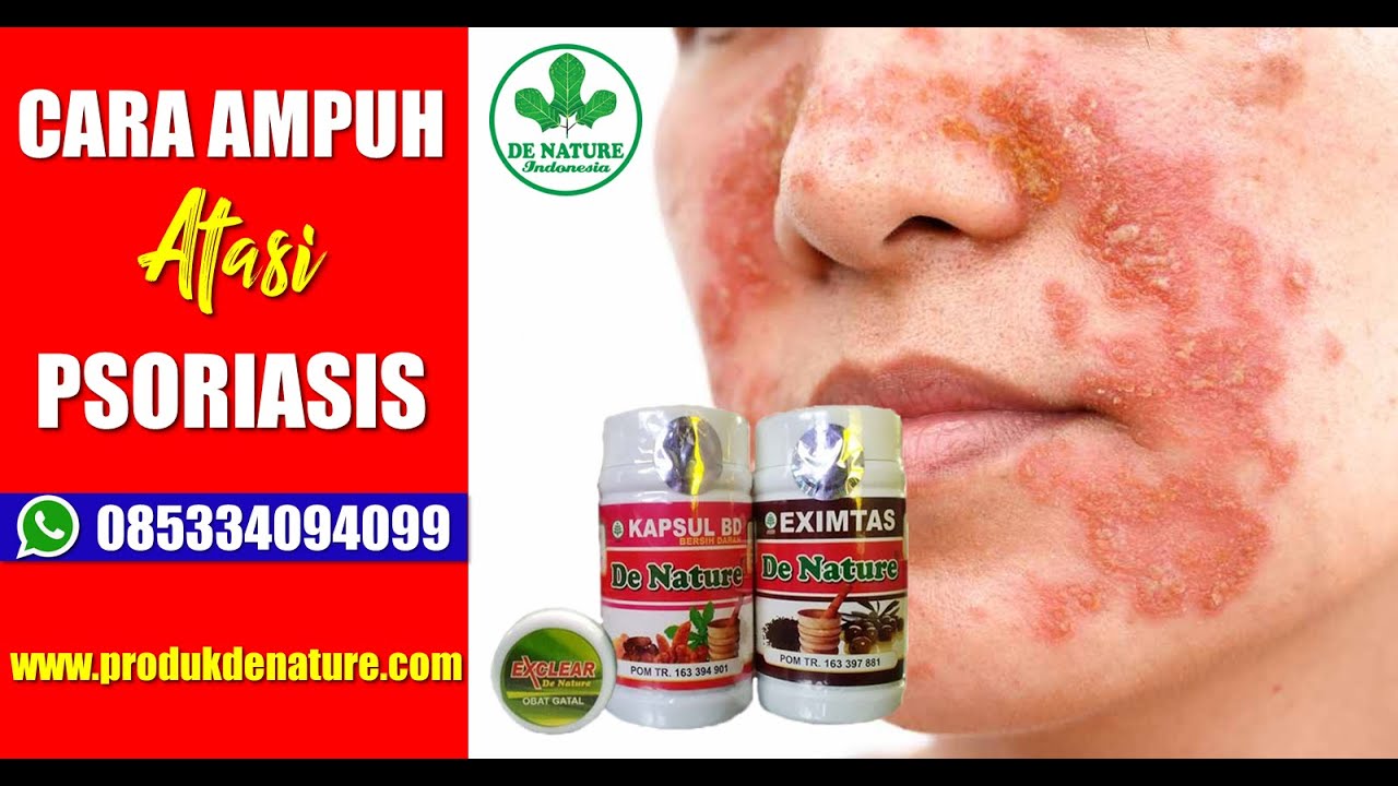 OBAT PSORIASIS DI APOTIK - Obat De Nature - YouTube