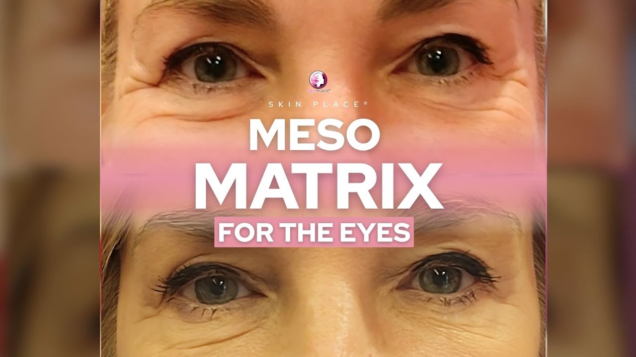 Skin Place Meso Matrix for the Eyes #MesoMatrix #Meso #ForTheEyes - YouTube
