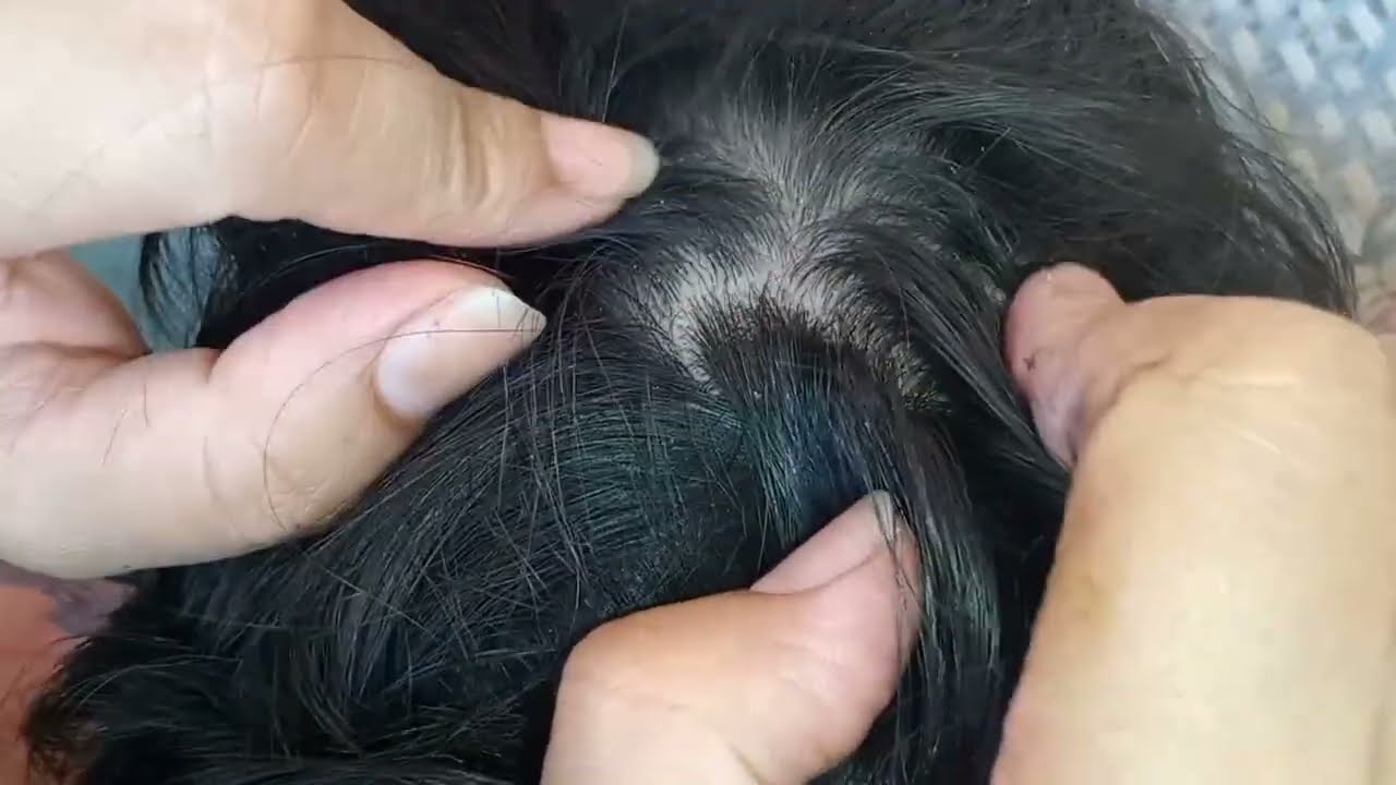 Original Dandruff Scratching By nails | Scalp Checking ASMR | Relax ...