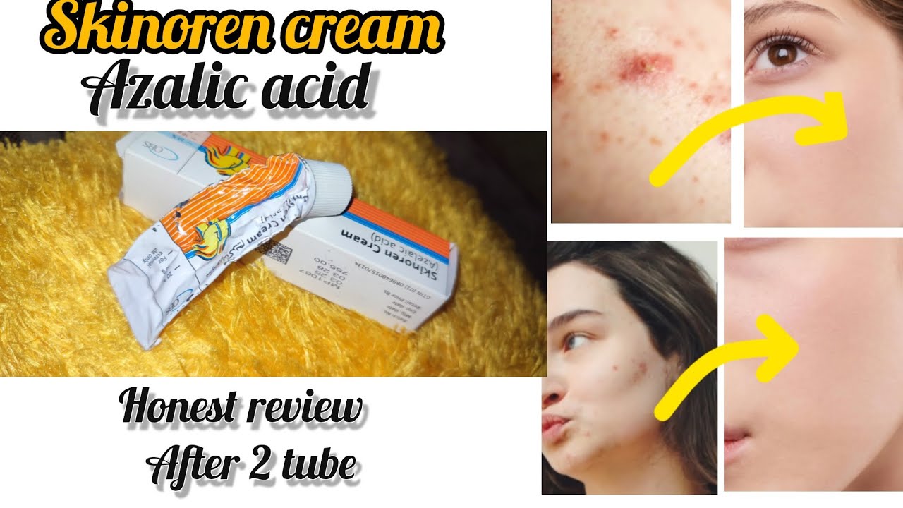 SKINOREN CREAM BEFORE AND AFTER || SKINOREN CREAM REVIEW - YouTube