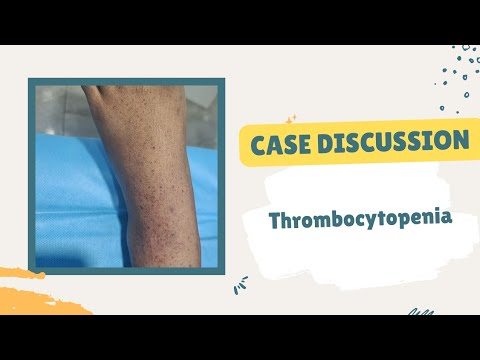 Case Discussion || Thrombocytopenia with Rash - YouTube
