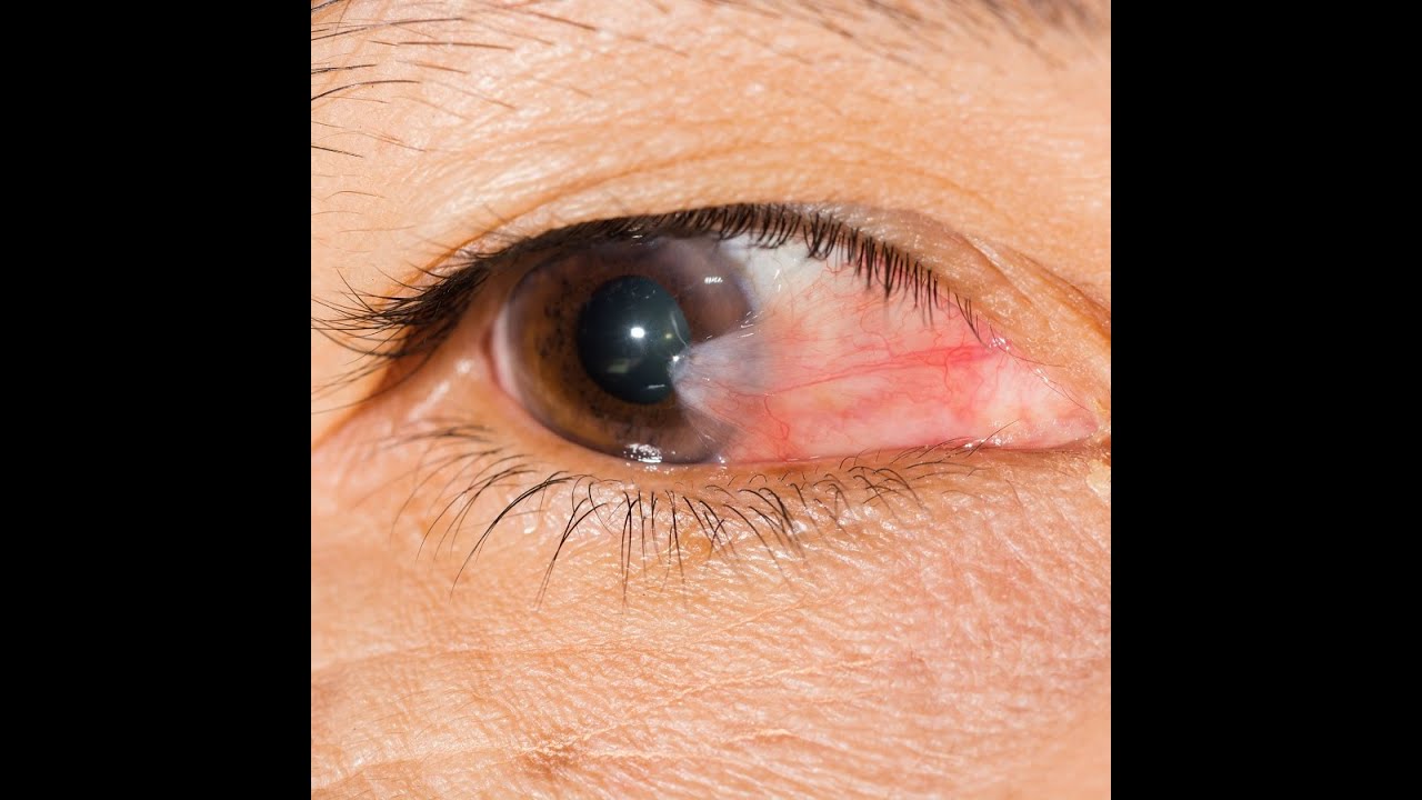 Pterygium or surfer's eye - YouTube