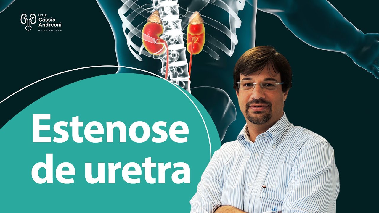 Estenose de Uretra | Dr. Cássio Andreoni Ribeiro CRM 78546 - YouTube