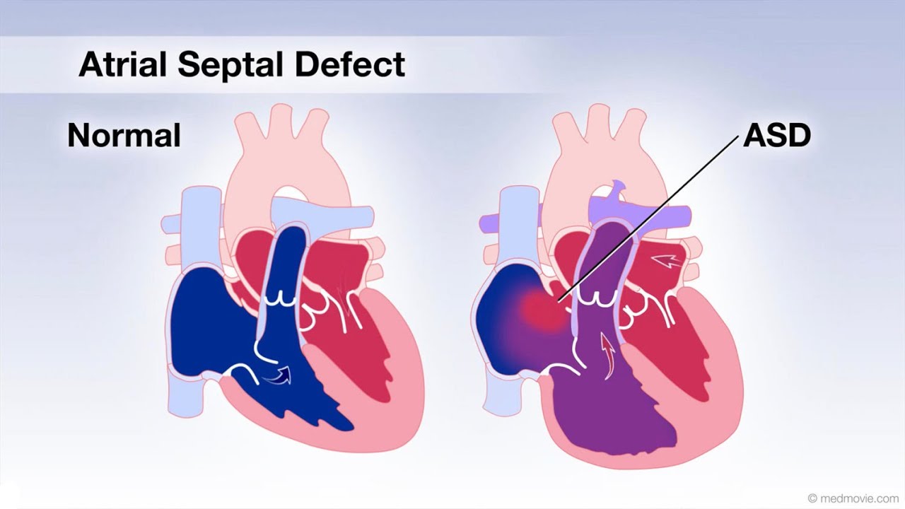 Quick review | Atrial Septal Defect | Congenital Heart Disease (2 ...