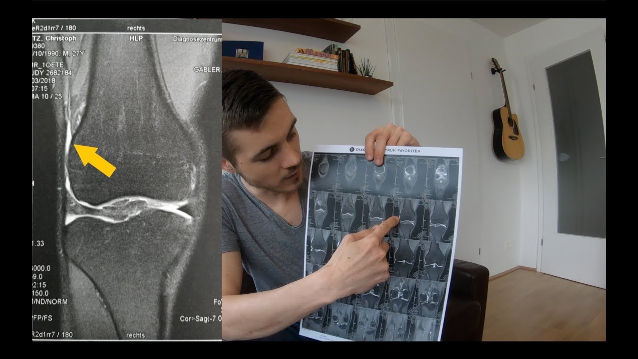 How ITB syndrom looks on MRI and what I do about it - YouTube