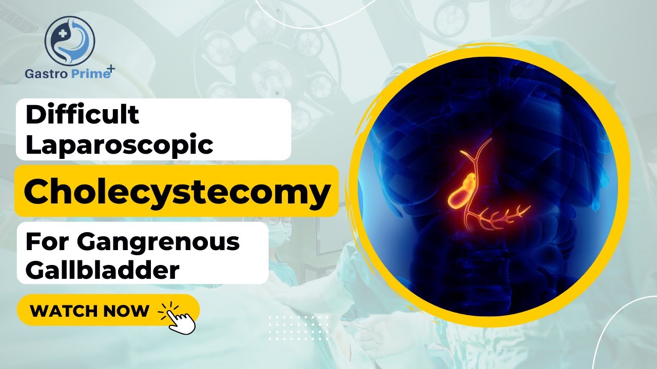 Difficult laparoscopic cholecystectomy for gangrenous gallbladder ...