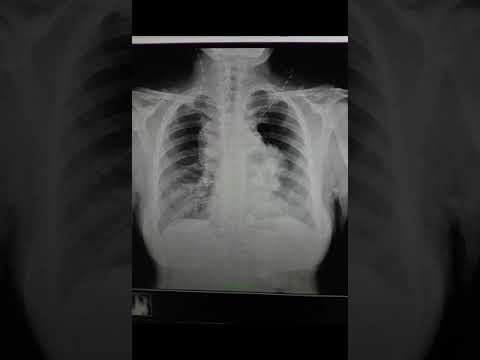 Dr Hilmi Keskin '' Akciğer kanseri akciğer grafisi ve tomografisi görüntüsü ''