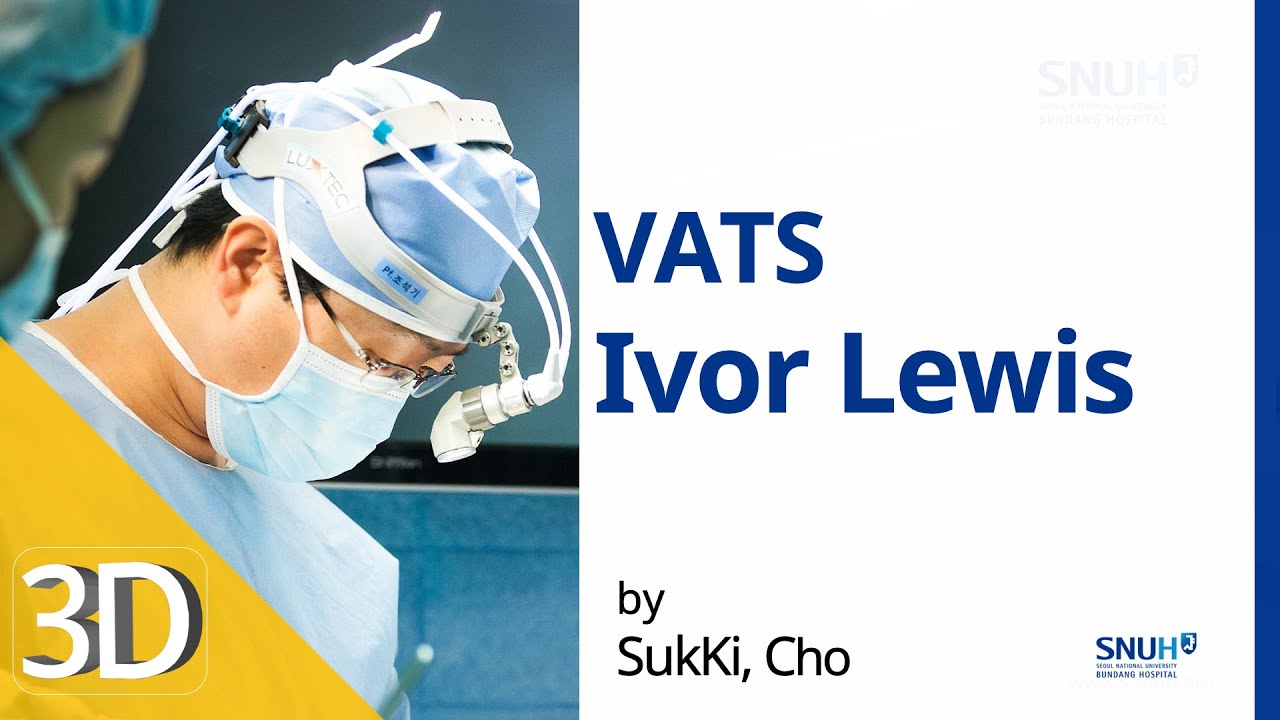 [3D] Ivor Lewis VATS (Video-Assisted Thoracoscopic Surgery) - YouTube