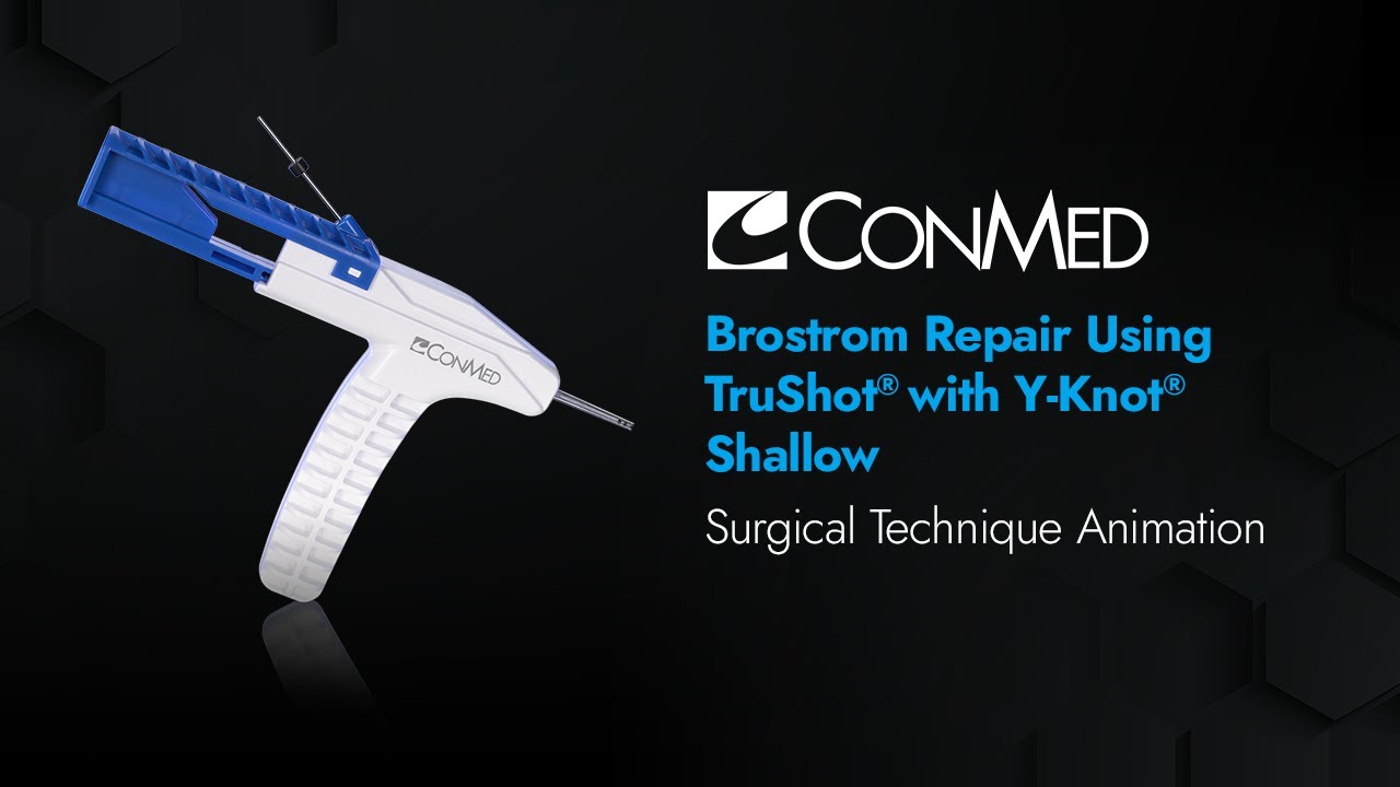 Brostrom Repair Using TruShot® with Y-Knot® Shallow - CONMED Animation ...