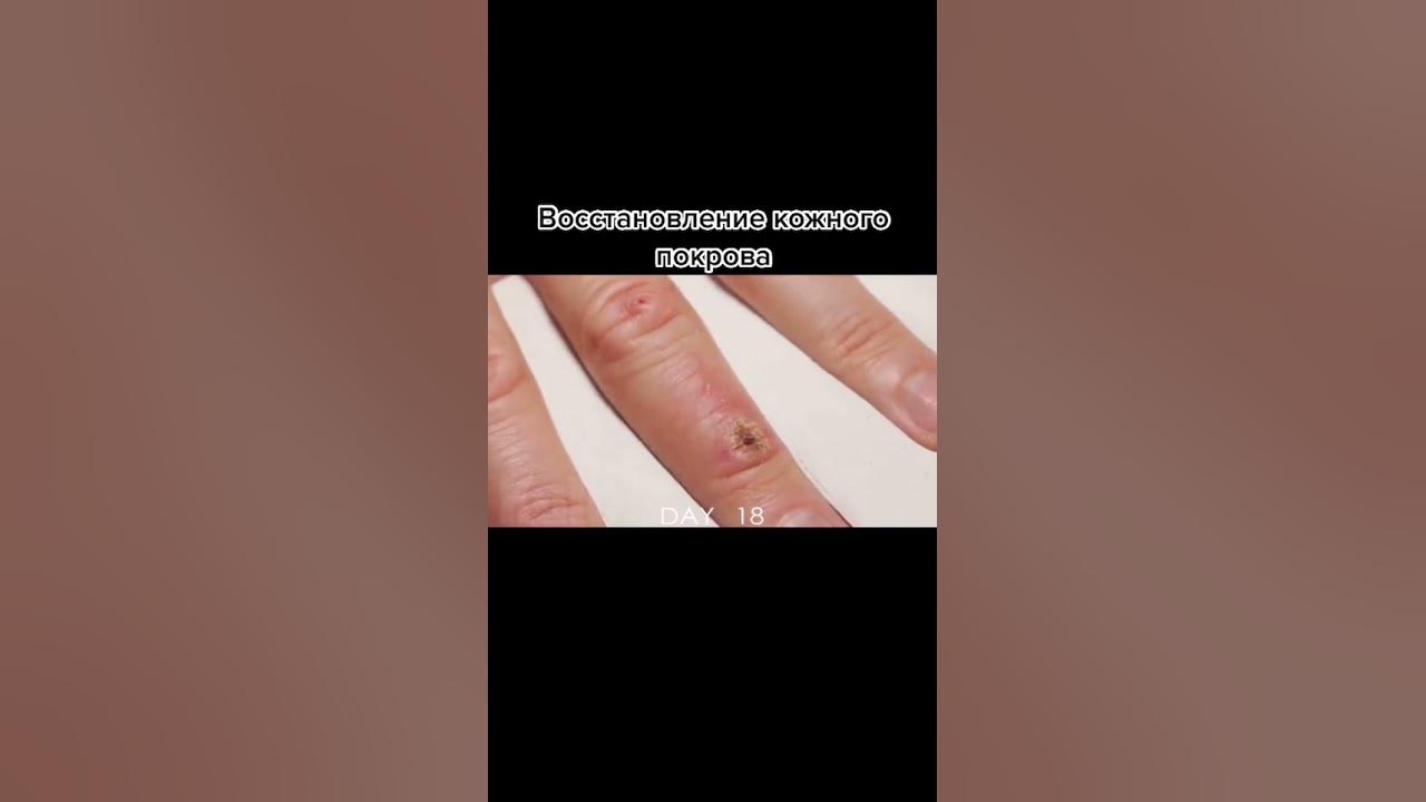Как заживает рана Youtube