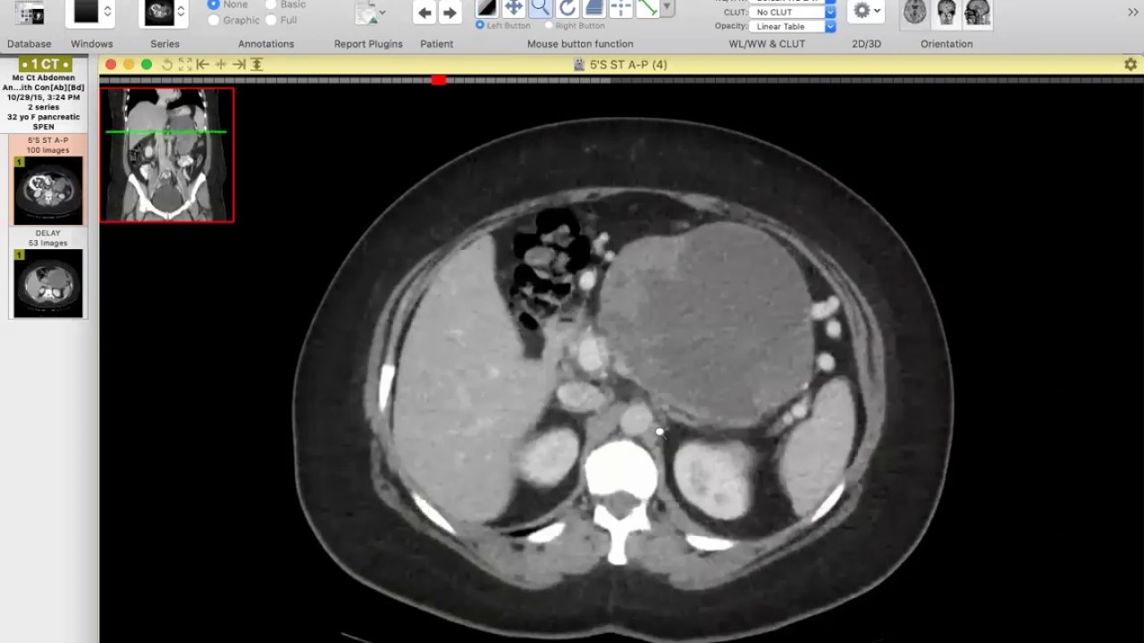Pancreatic tail mass in young woman (Solid pseudopapillary tumor of the ...