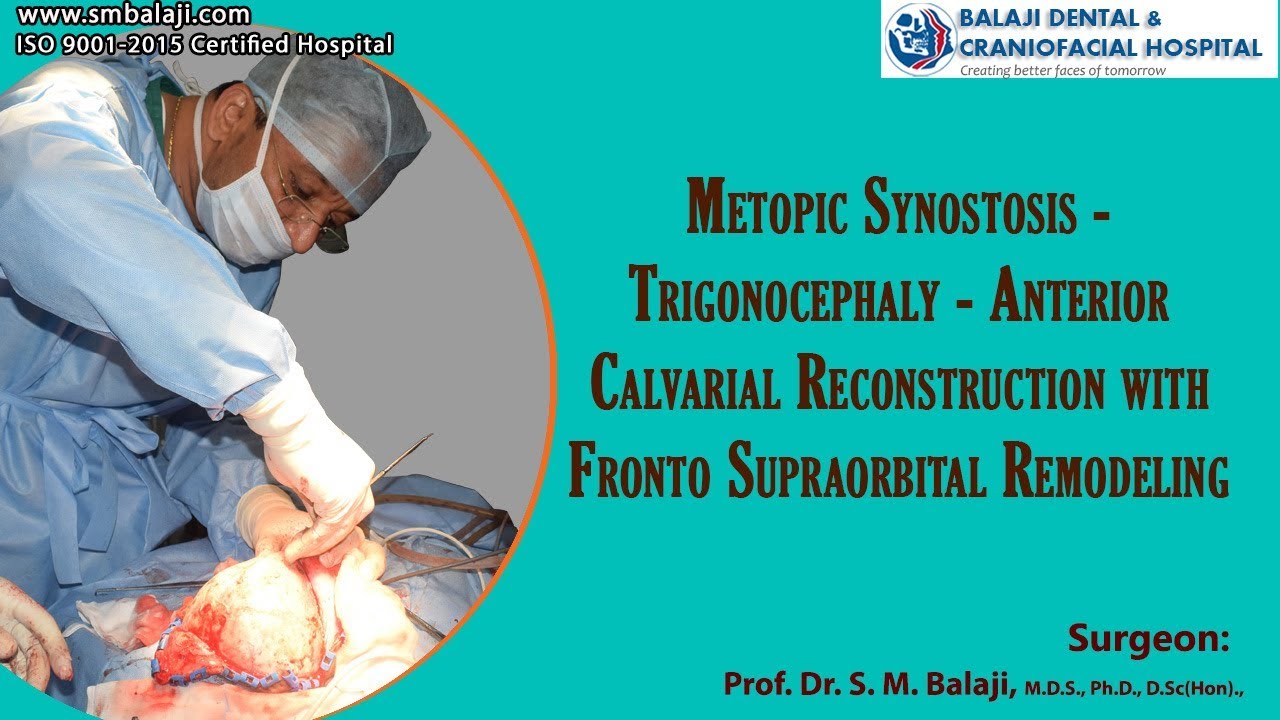 Metopic synostosis - Trigonocephaly - Anterior Calvarial Reconstruction ...