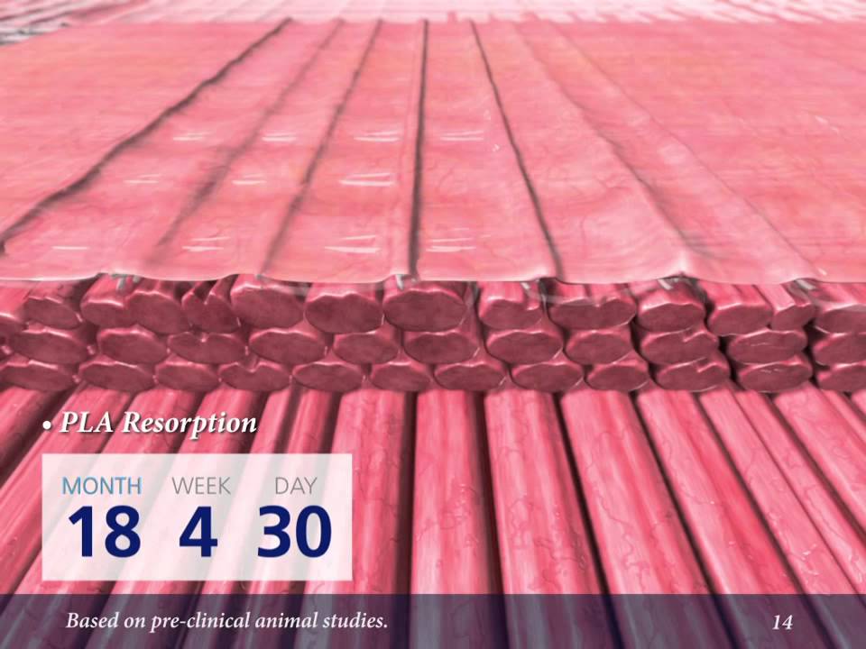 ProGrip™ Laparoscopic Self Fixating Mesh Overview - YouTube