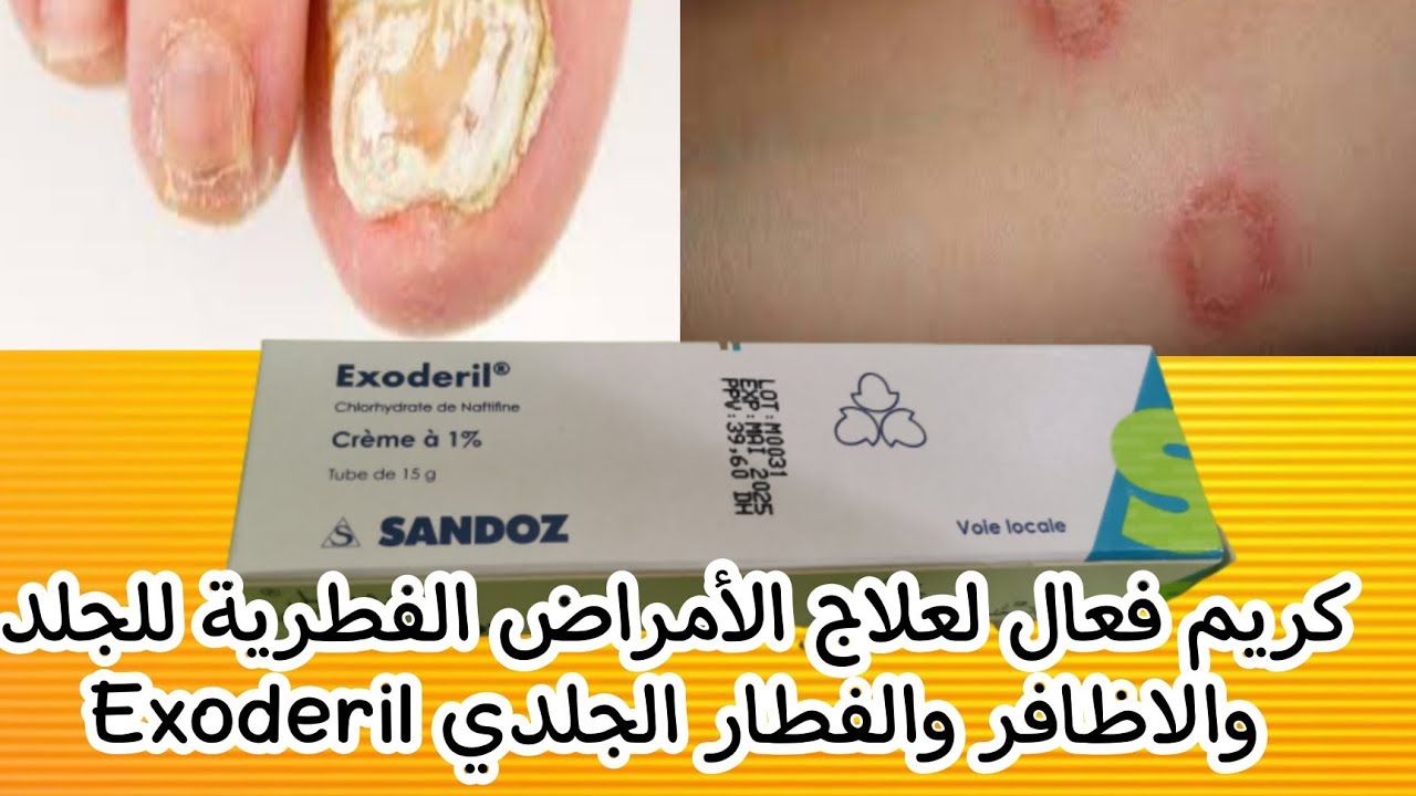 كريم فعال لعلاج الأمراض الفطرية للجلد وسعفات الاظافر والفطار الجلدي Exoderil - YouTube