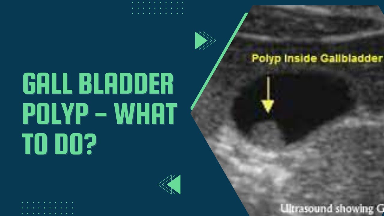 Gallbladder polyp: क्या गॉलब्लैडर पॉलिप कैंसर को दे सकता है दावत? घबराओ ...