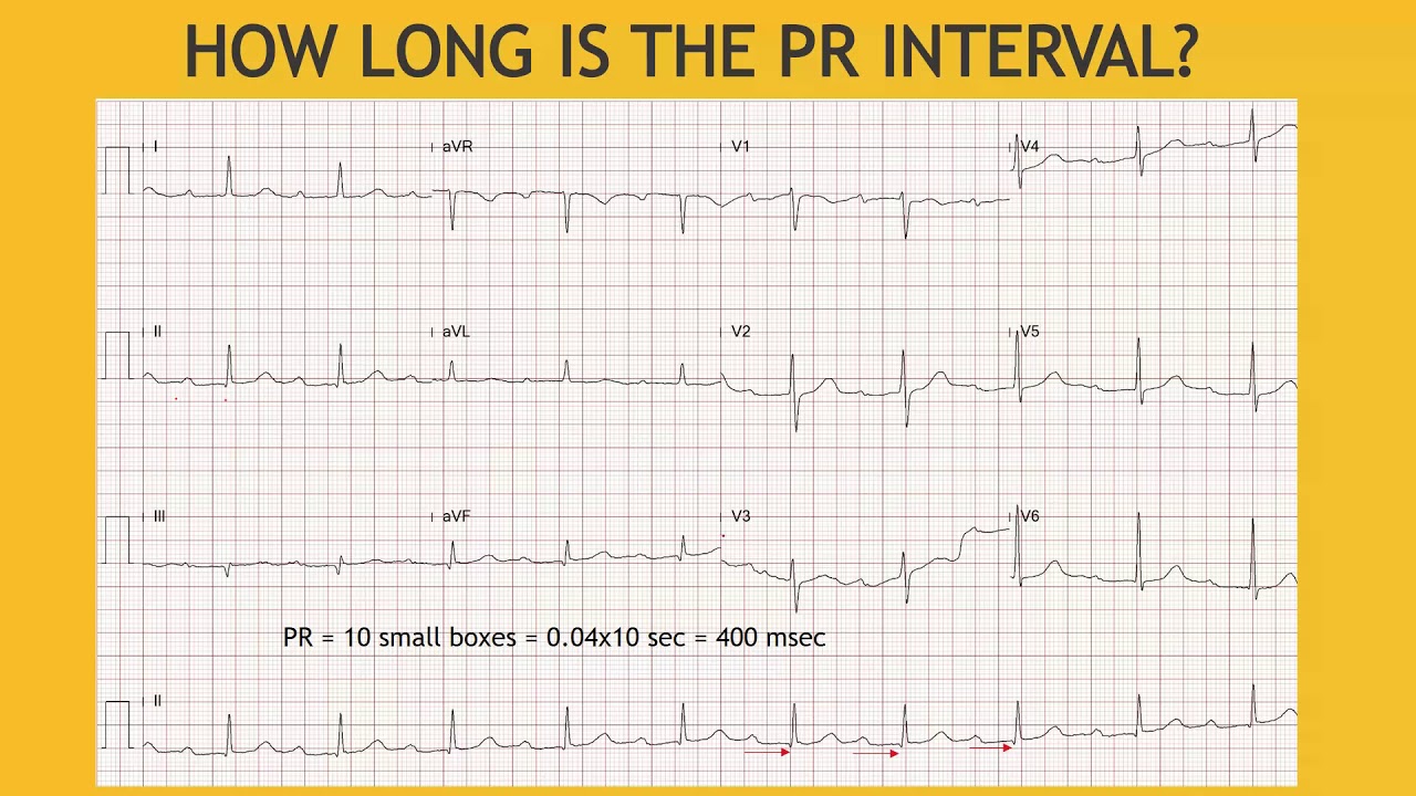 Basic ECG Interpretation 6/9: PR interval and AV Block - YouTube
