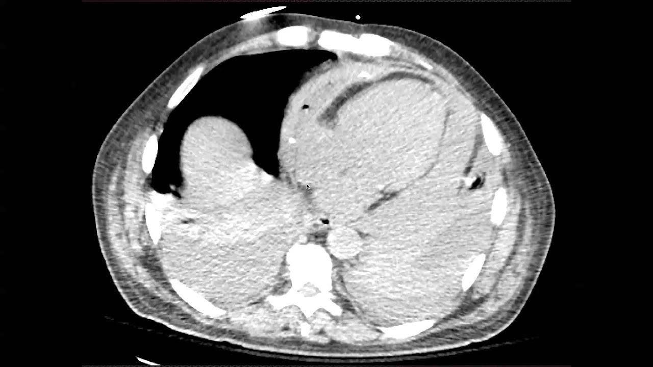 Pericardial Abscess and Tamponade - YouTube