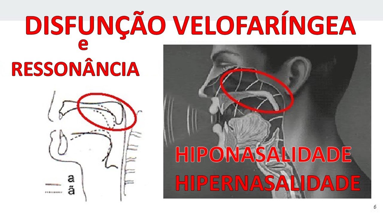 Disfuncao Velofaringea