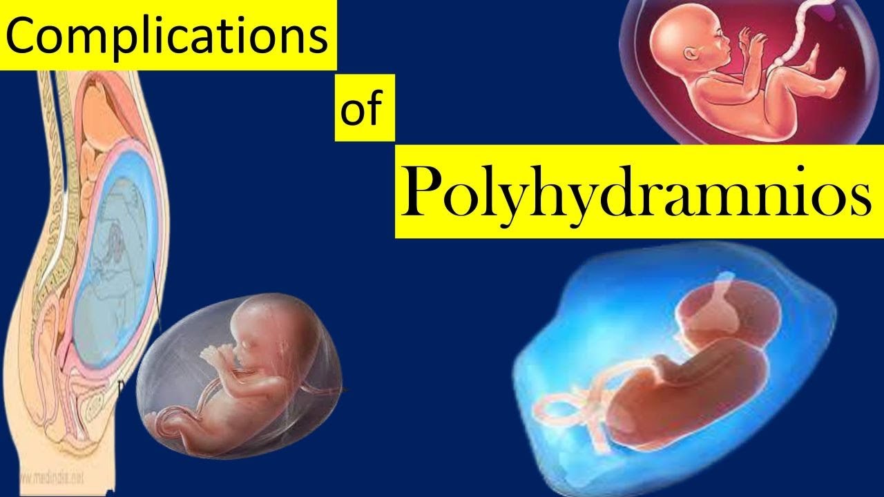 Complications of Polyhydramnios - YouTube