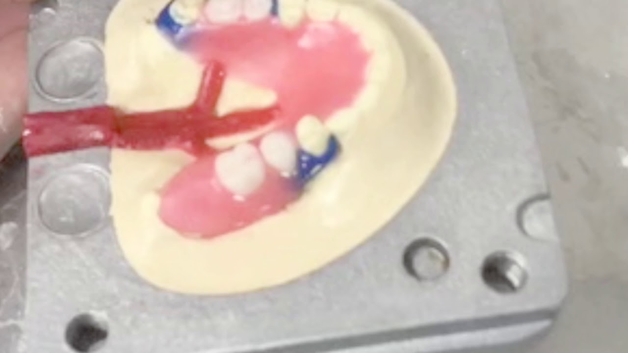 DuraFlex Partials, Start to Finish in Only 3 Minutes? - YouTube