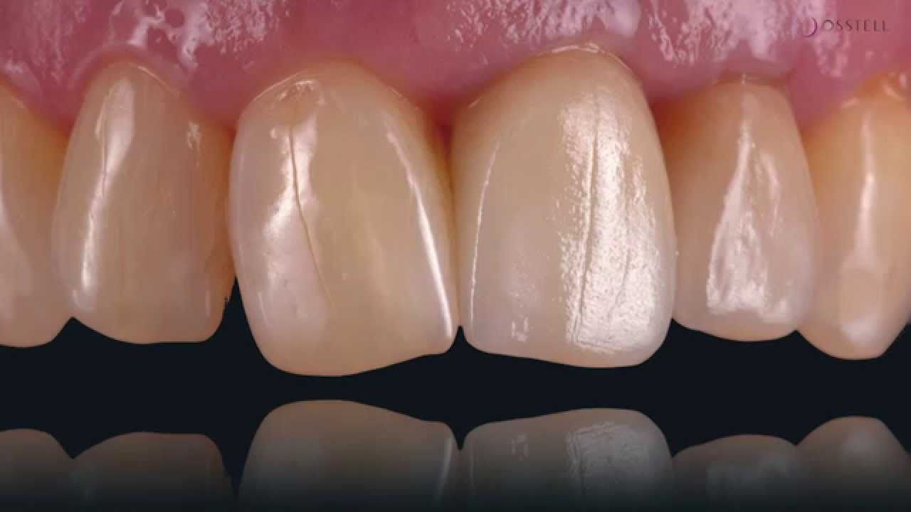 Basic principles of the Osstell technique by Dr. Marcus Dagnelid - YouTube