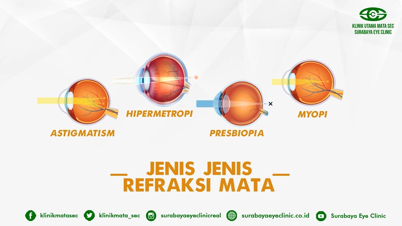 Inilah Jenis-jenis Refraksi Mata -Surabaya eye clinic - YouTube