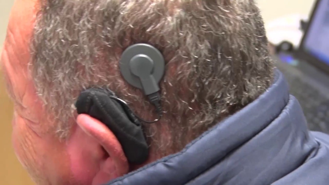 Avances en implantes cocleares - YouTube