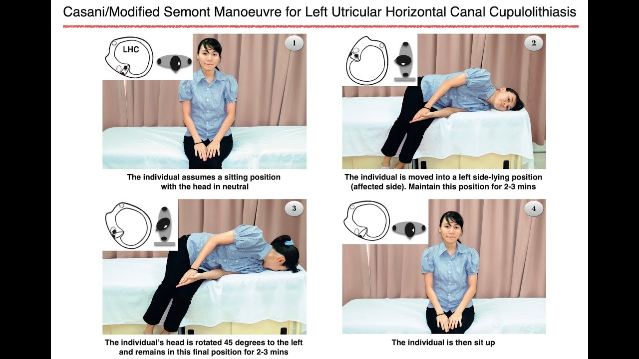 Casani/Modified Semont Manoeuvre for Left Utricular Horizontal Canal ...