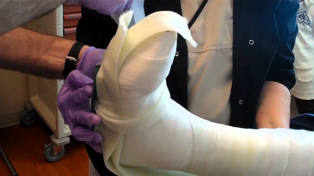 Ulcer Debridement with Total Contact Cast Part 2 - YouTube