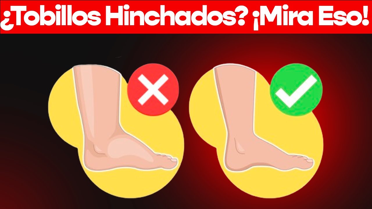 Acabe Con La Hinchazón: ¡Soluciones Efectivas Para Edema En Pies Y ...