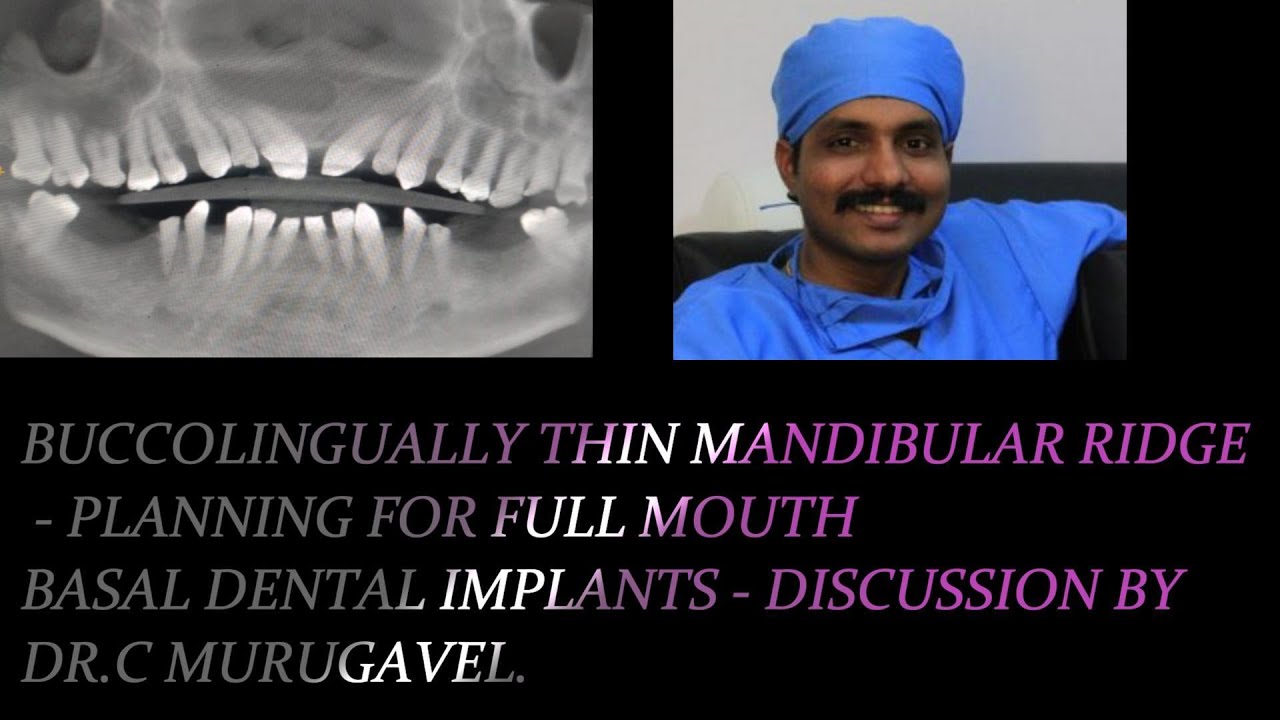 Buccolingually thin mandibular ridge-Planning for full mouth basal ...