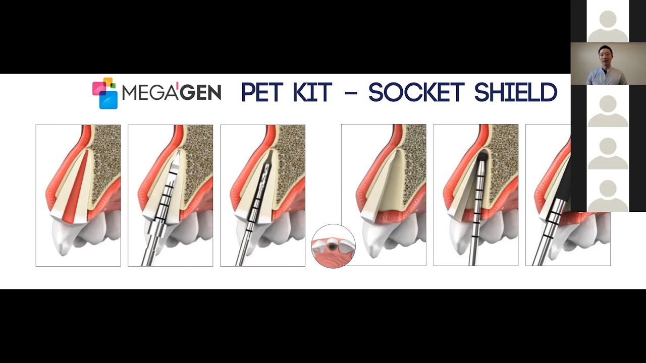 MegaGen PET KIT - "Challenges and Solutions for Aesthetic Anterior ...