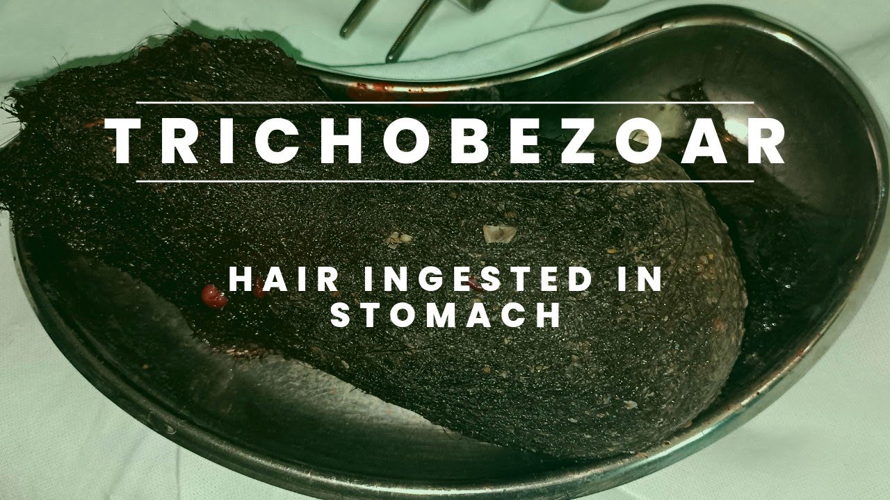Trichobezoar surgery || Hairball in stomach || Surgery - YouTube