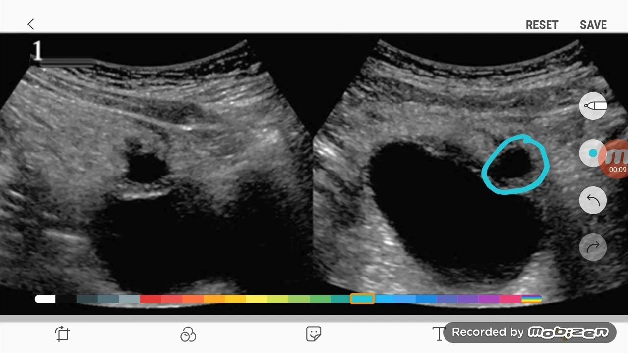 Urachal Cyst On Ultrasound Youtube
