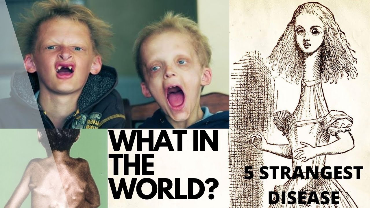 5 strangest disease in the world - YouTube