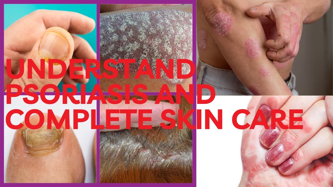 Understanding Psoriasis And Complete Skincare Guide Youtube