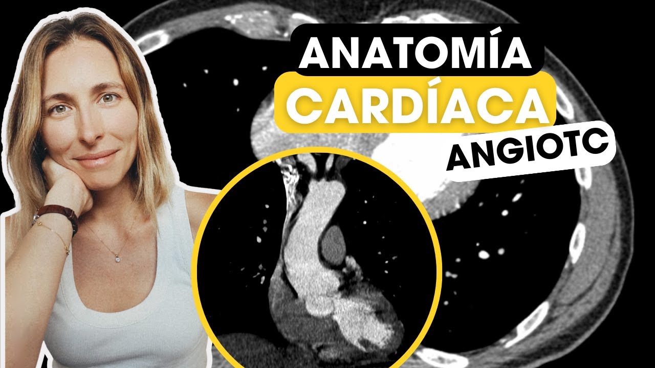 Todo lo que tienes que saber sobre anatomía cardíaca por TC! - YouTube