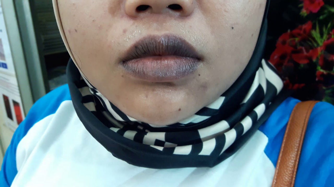 Contact dermatitis lips with post inflammatory hyperpigmentation - YouTube