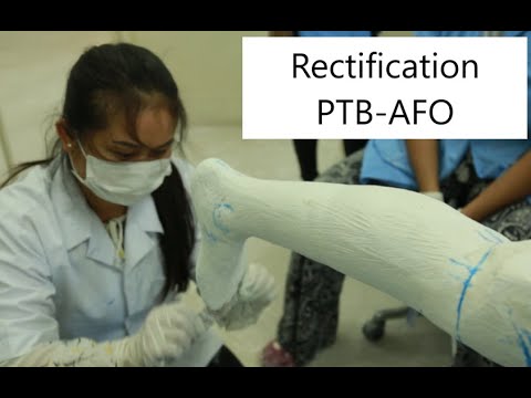 Reduction PTB-AFO (Part 2) - YouTube