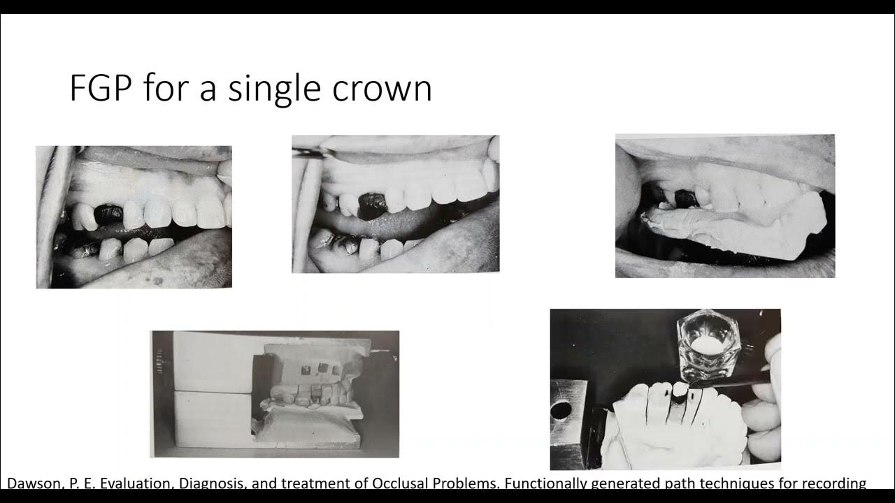 Fixed Partial Denture Part II Functionally generated path by Dr Rahul ...